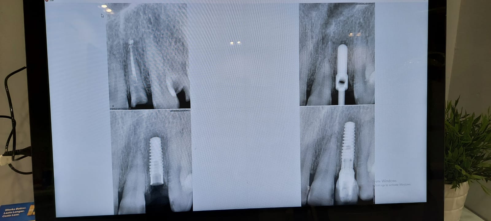 radix | Implants & Biomaterials - Prothetik